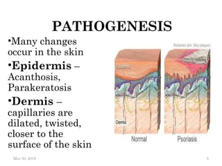 Psoriasis (dermatology) | PPT