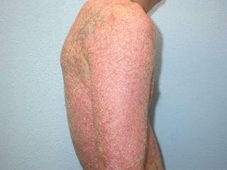 Psoriasis Developed By Koebner Phenomenon After Radiation Therapy | PPT