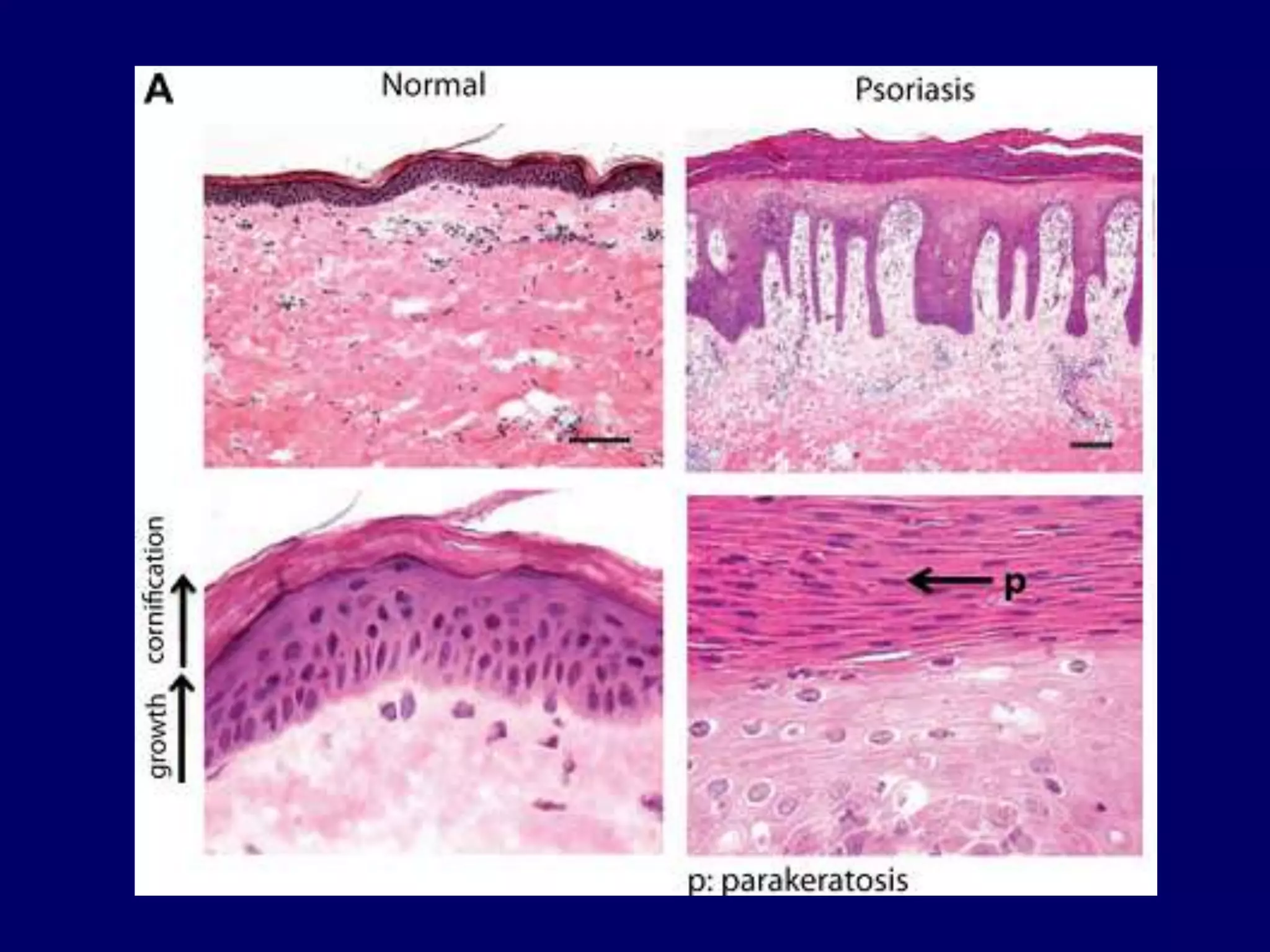 Psoriasis khyzhnyak | PPT