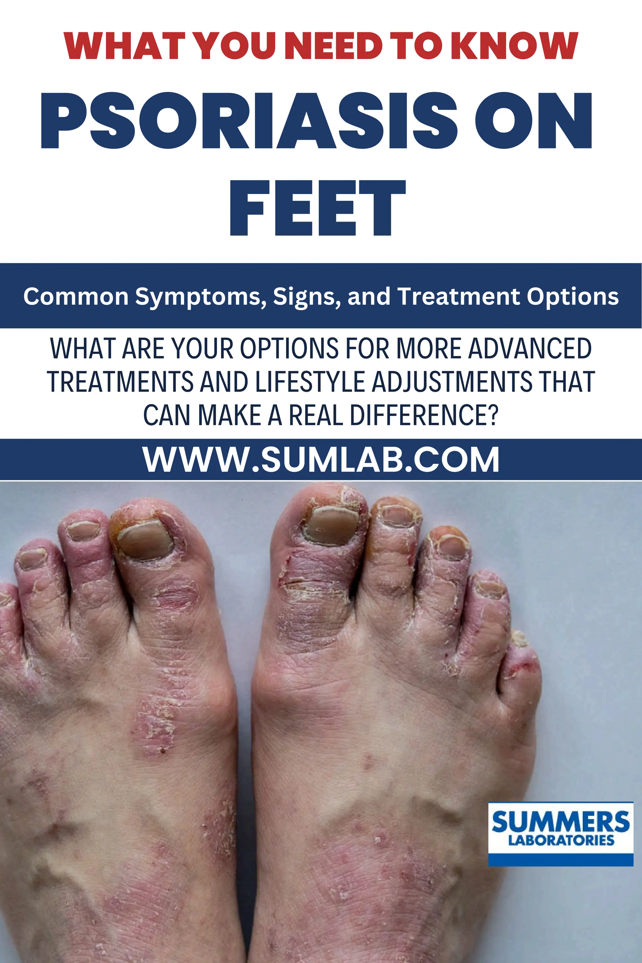 What are the early signs of psoriasis on the feet? | PDF