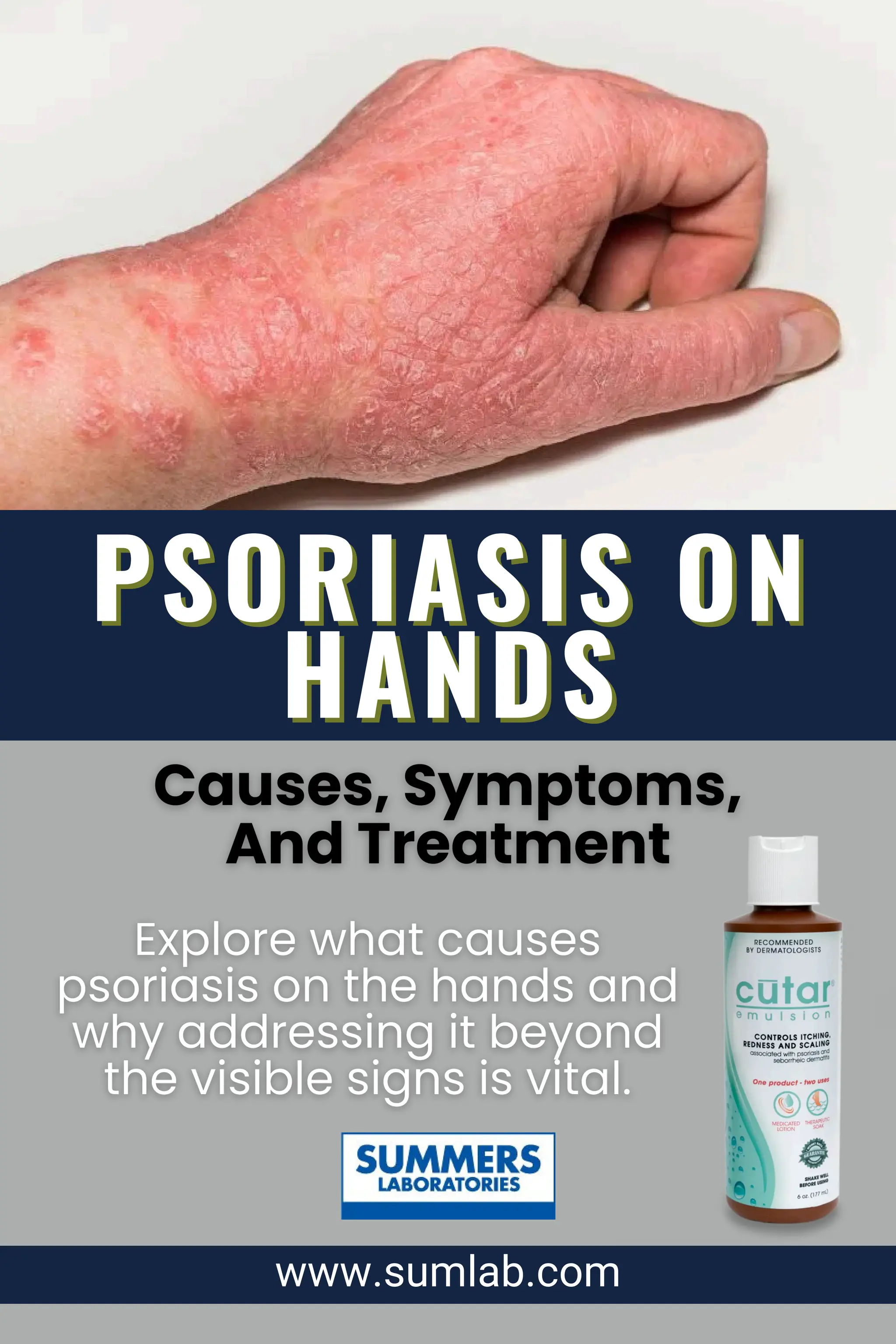 How can hand psoriasis be treated? | Skin care | PDF