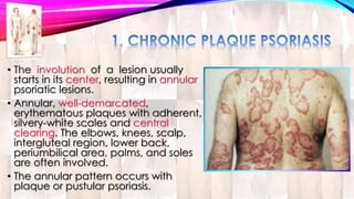 Psoriasis part1 | PPTX