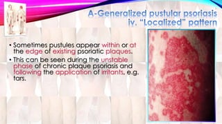 Psoriasis part1 | PPTX
