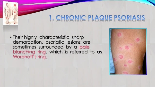 Psoriasis part1