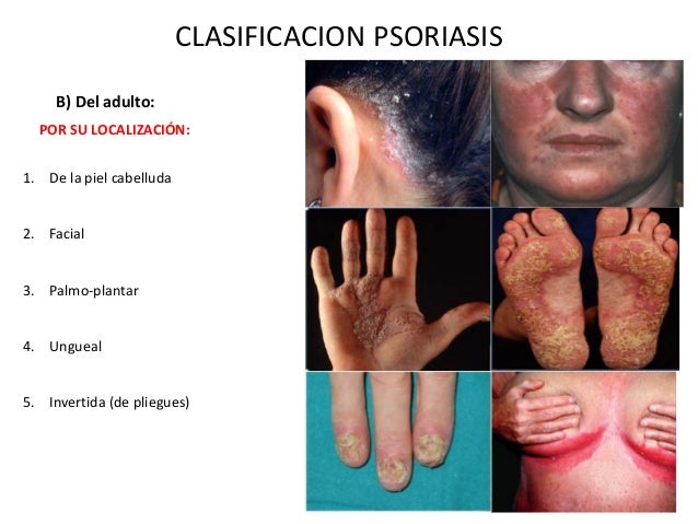 Psoriasis
