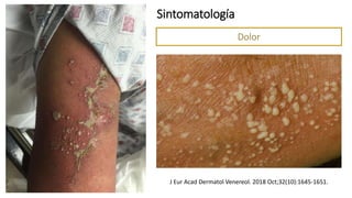 Psoriasis Pustulosa Generalizada | PPTX