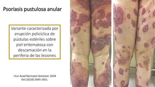 Psoriasis Pustulosa Generalizada | PPTX