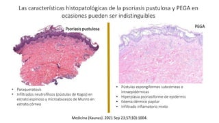 Psoriasis Pustulosa Generalizada | PPTX