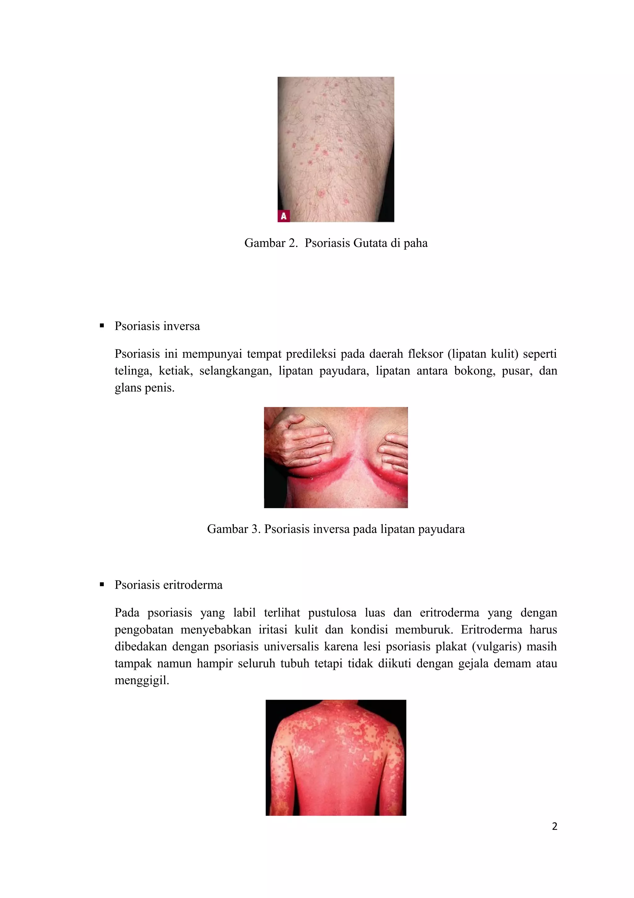 Psoriasis vulgaris | DOC
