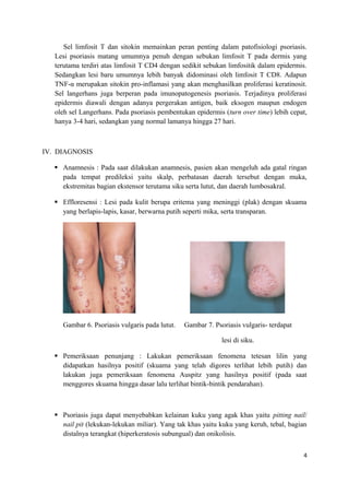 Psoriasis vulgaris | DOC