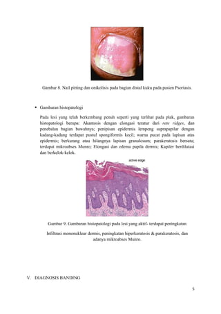 Psoriasis vulgaris | DOC