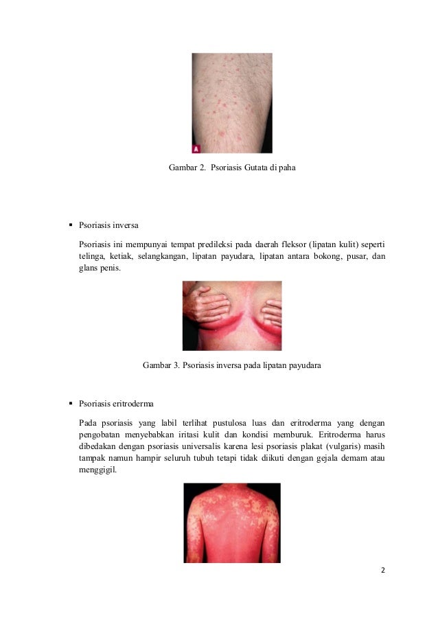 Gejala Klinis Dan Terapi Psoriasis Pustulosa Generalisata Tipe – Netzdot