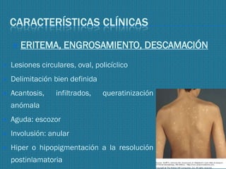 Psoriasis y pitiriasis rosada | PPTX