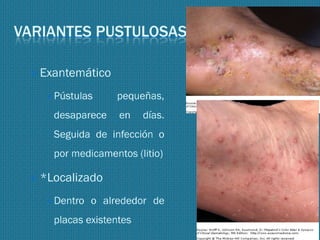 Psoriasis y pitiriasis rosada | PPTX