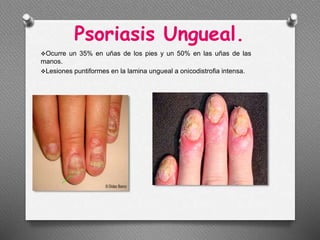 Seminario Psoriasis | PPTX