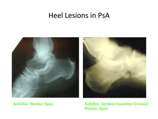Psoriatic arthritis clinical features & epidemiology. | PDF