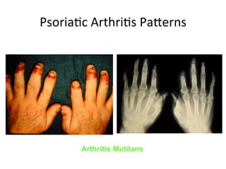 Psoriatic arthritis clinical features & epidemiology. | PDF