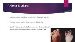 Psoriatic arthritis | PPTX