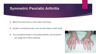Psoriatic arthritis | PPTX