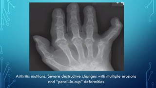 Psoriatic arthritis | PDF