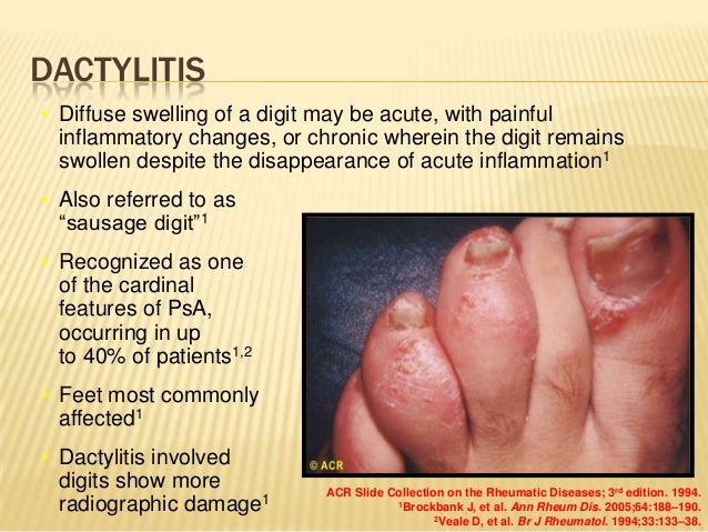 Psoriatic arthropathy