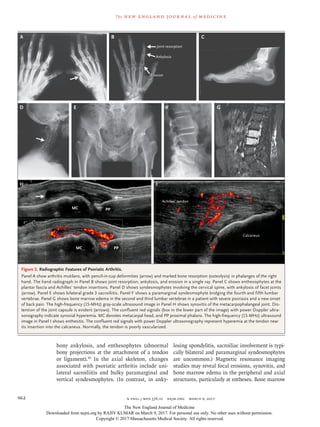Psoriatic arthropathy | PDF