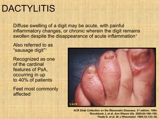 Psoriatric arthritis | PPT