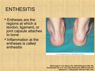Psoriatric arthritis | PPT