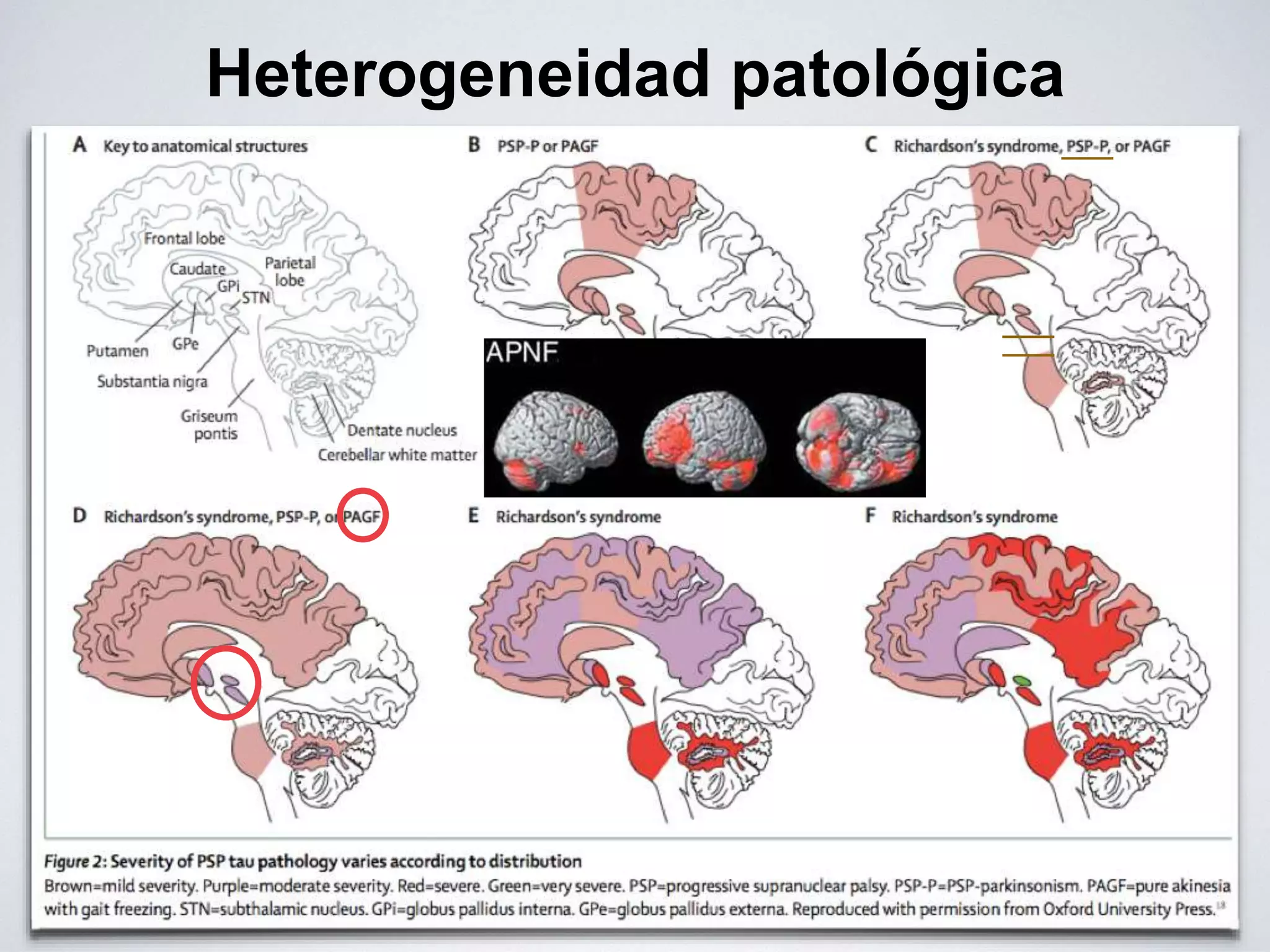 Paralisis Supranuclear Progresiva cambios-clínicopatológicos | PPTX