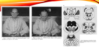 PARALISIS SUPRANUCLEAR PROGRESIVA,DEGENERACION CORTICOBASAL, ATROFIA ...