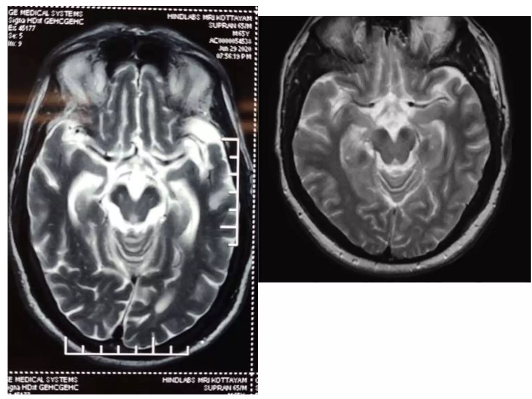 PROGRESSIVE SUPRANUCLEAR PALSY-MRI SPOTTER WITH OTHER IMAGING SIGNS | PPT