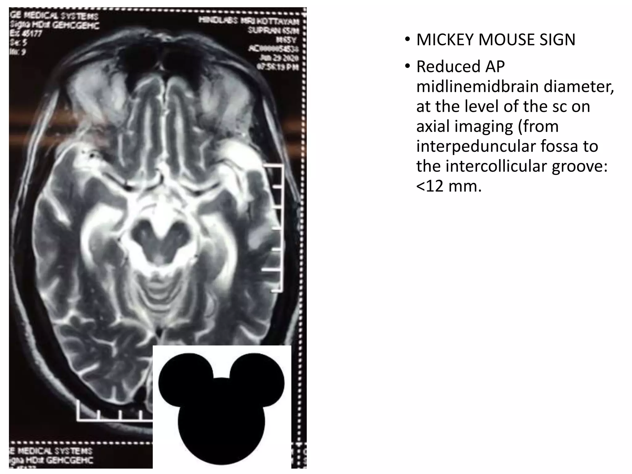 PROGRESSIVE SUPRANUCLEAR PALSY-MRI SPOTTER WITH OTHER IMAGING SIGNS | PPT