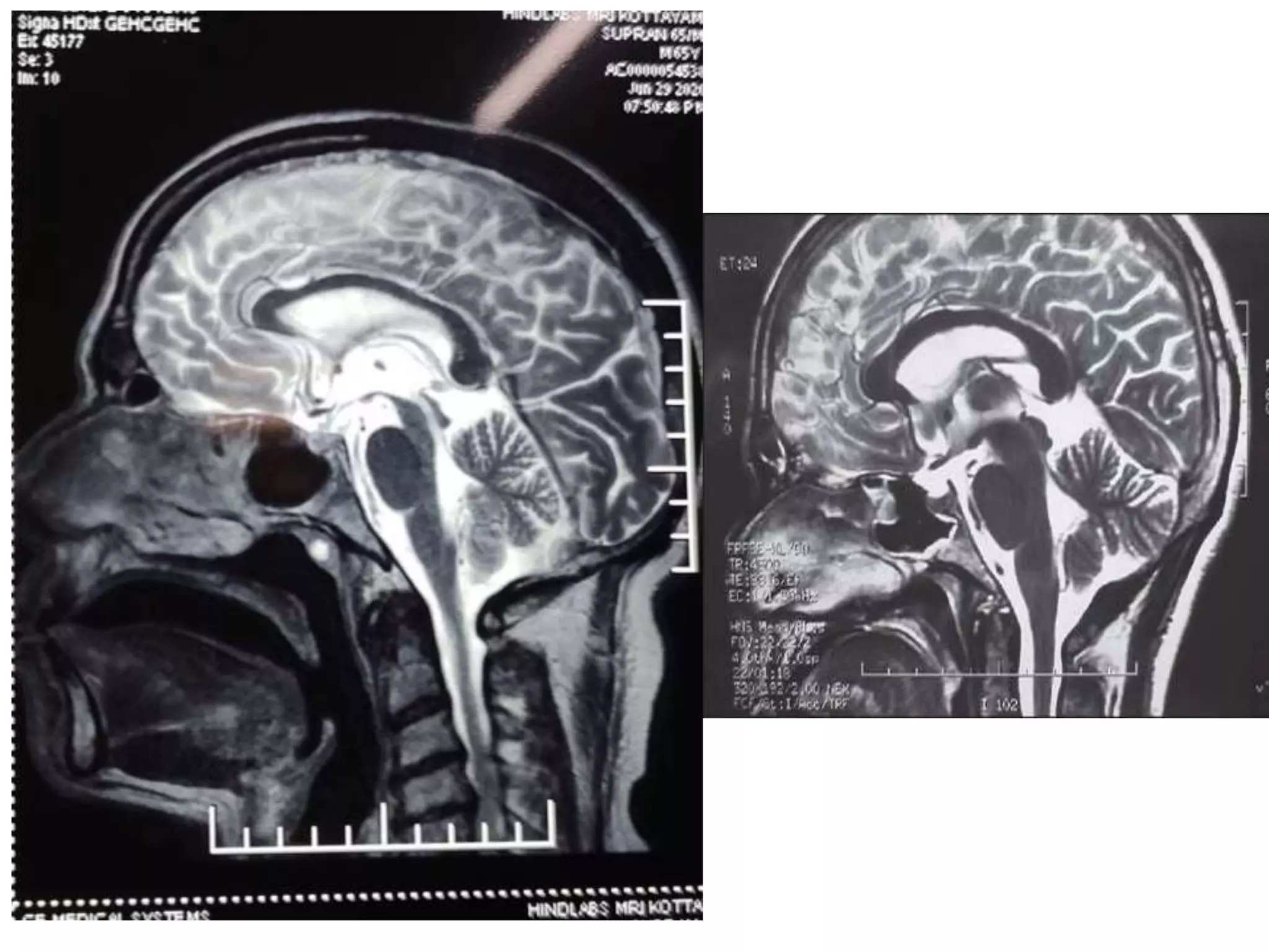 PROGRESSIVE SUPRANUCLEAR PALSY-MRI SPOTTER WITH OTHER IMAGING SIGNS | PPT