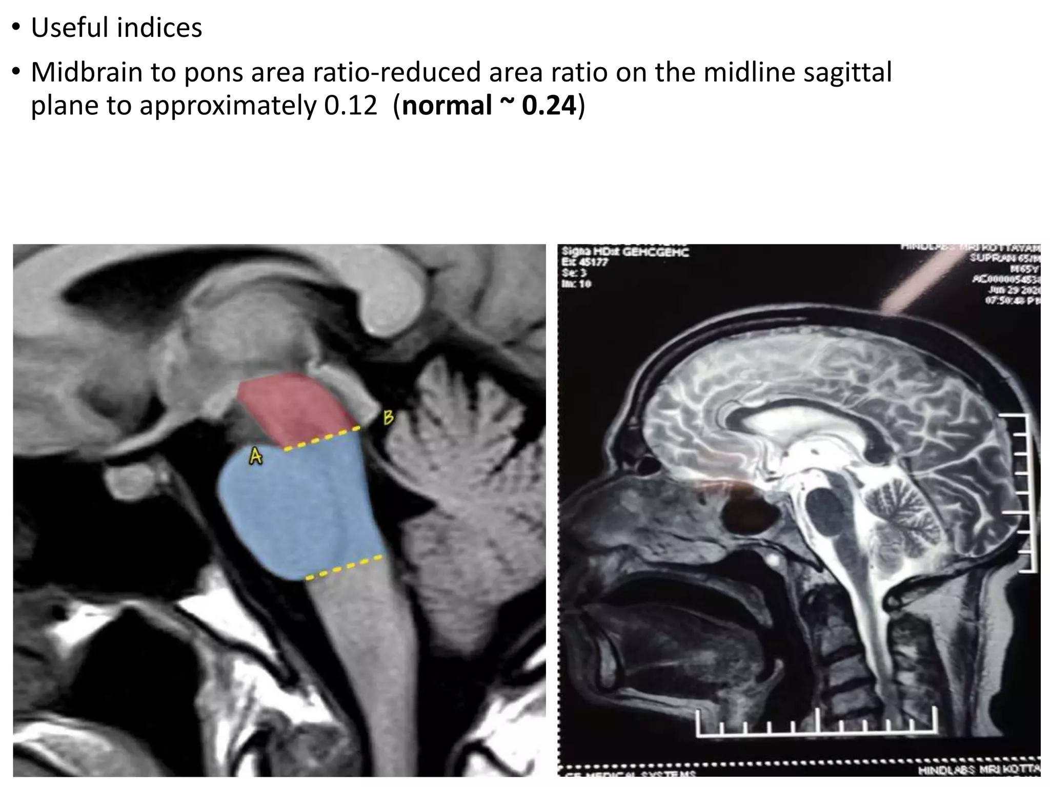 PROGRESSIVE SUPRANUCLEAR PALSY-MRI SPOTTER WITH OTHER IMAGING SIGNS | PPT