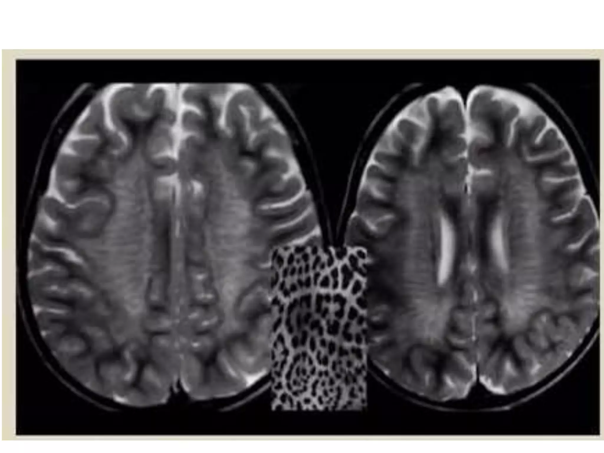 PROGRESSIVE SUPRANUCLEAR PALSY-MRI SPOTTER WITH OTHER IMAGING SIGNS | PPT