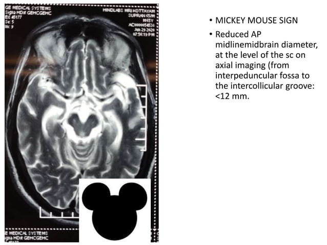 PROGRESSIVE SUPRANUCLEAR PALSY-MRI SPOTTER WITH OTHER IMAGING SIGNS | PPT