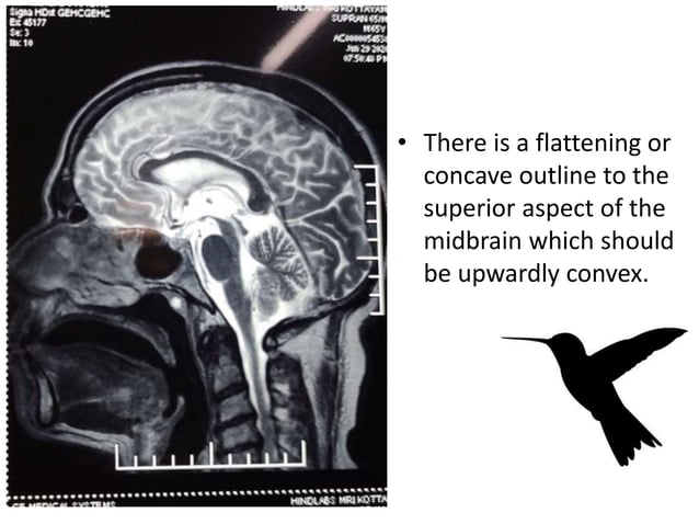 PROGRESSIVE SUPRANUCLEAR PALSY-MRI SPOTTER WITH OTHER IMAGING SIGNS | PPT