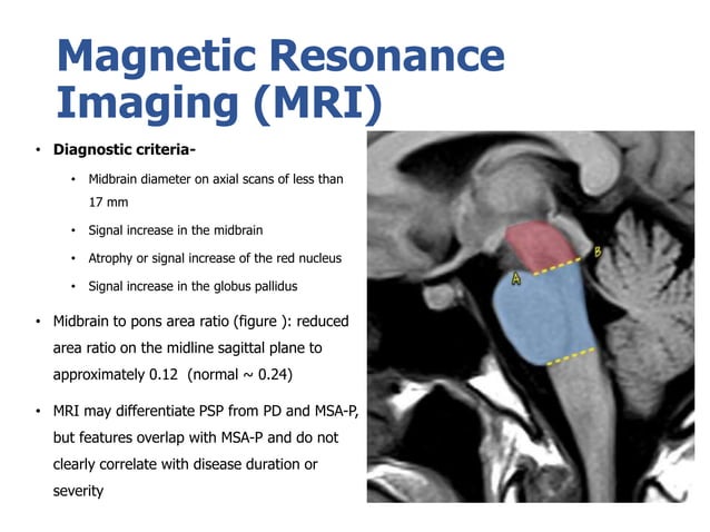 Progressive supranuclear palsy and multiple system atrophy | PPT