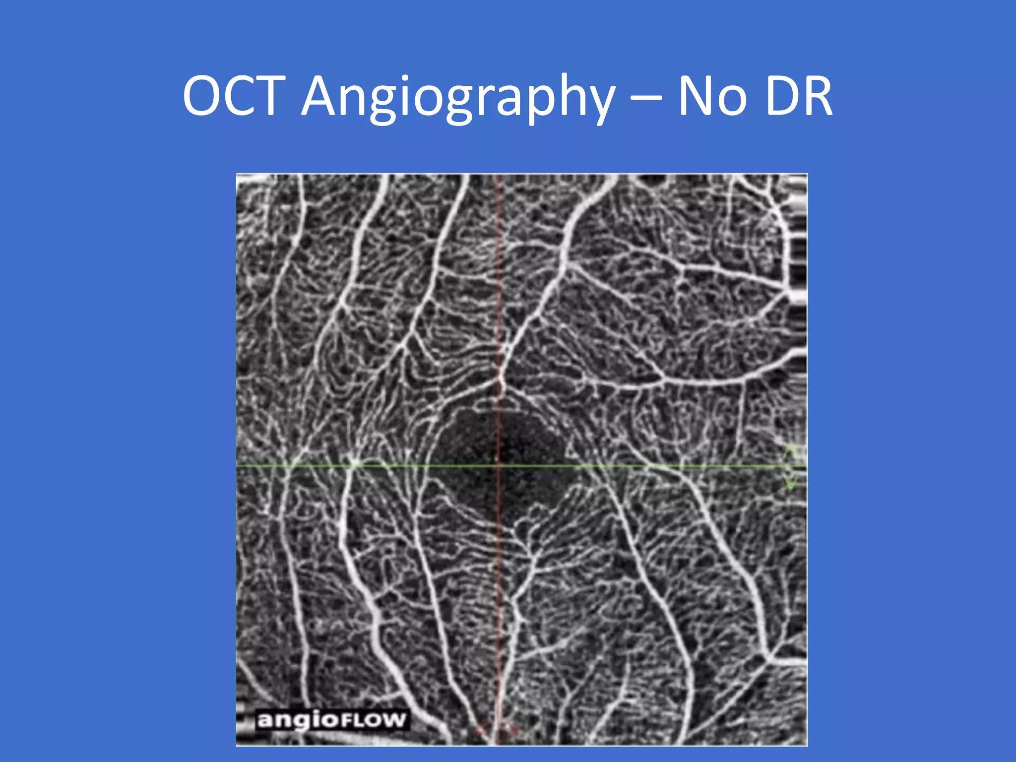 Peter Scanlon: diabetic eye screening, past present and future part 2 | PPT