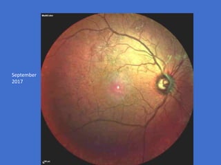 Peter Scanlon: diabetic eye screening, past present and future part 2 | PPT