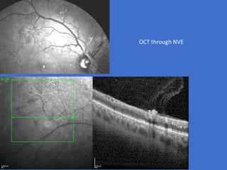 Peter Scanlon: diabetic eye screening, past present and future part 2 | PPT