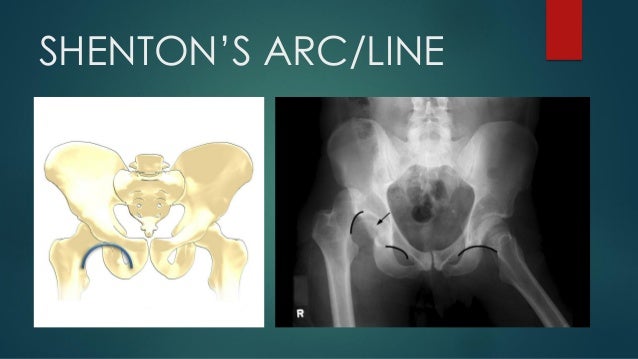 PS SESSION : EXAMINATION OF HIP