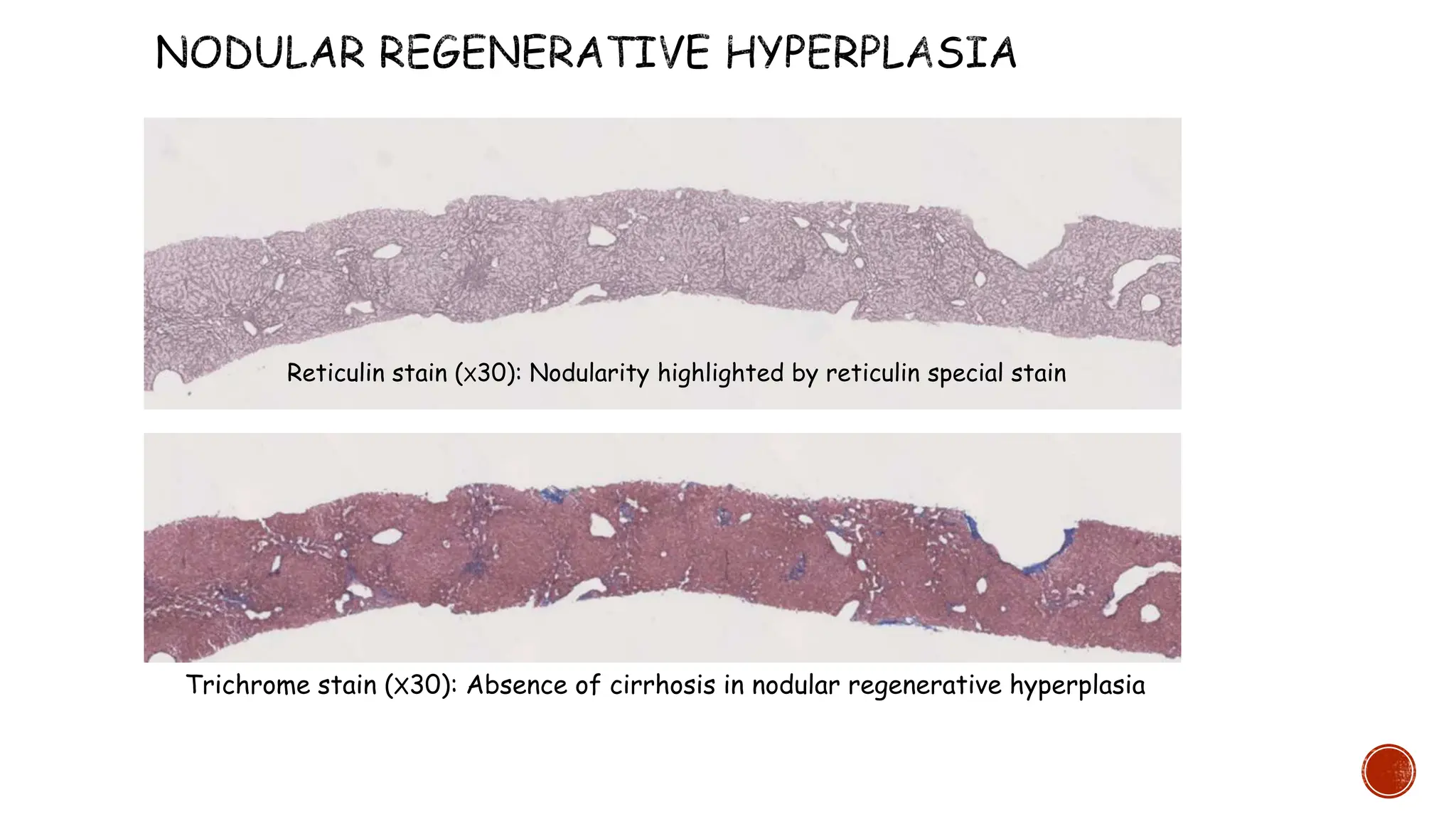 Portosinusoidal Vascular Disease (PSVD) | PPTX