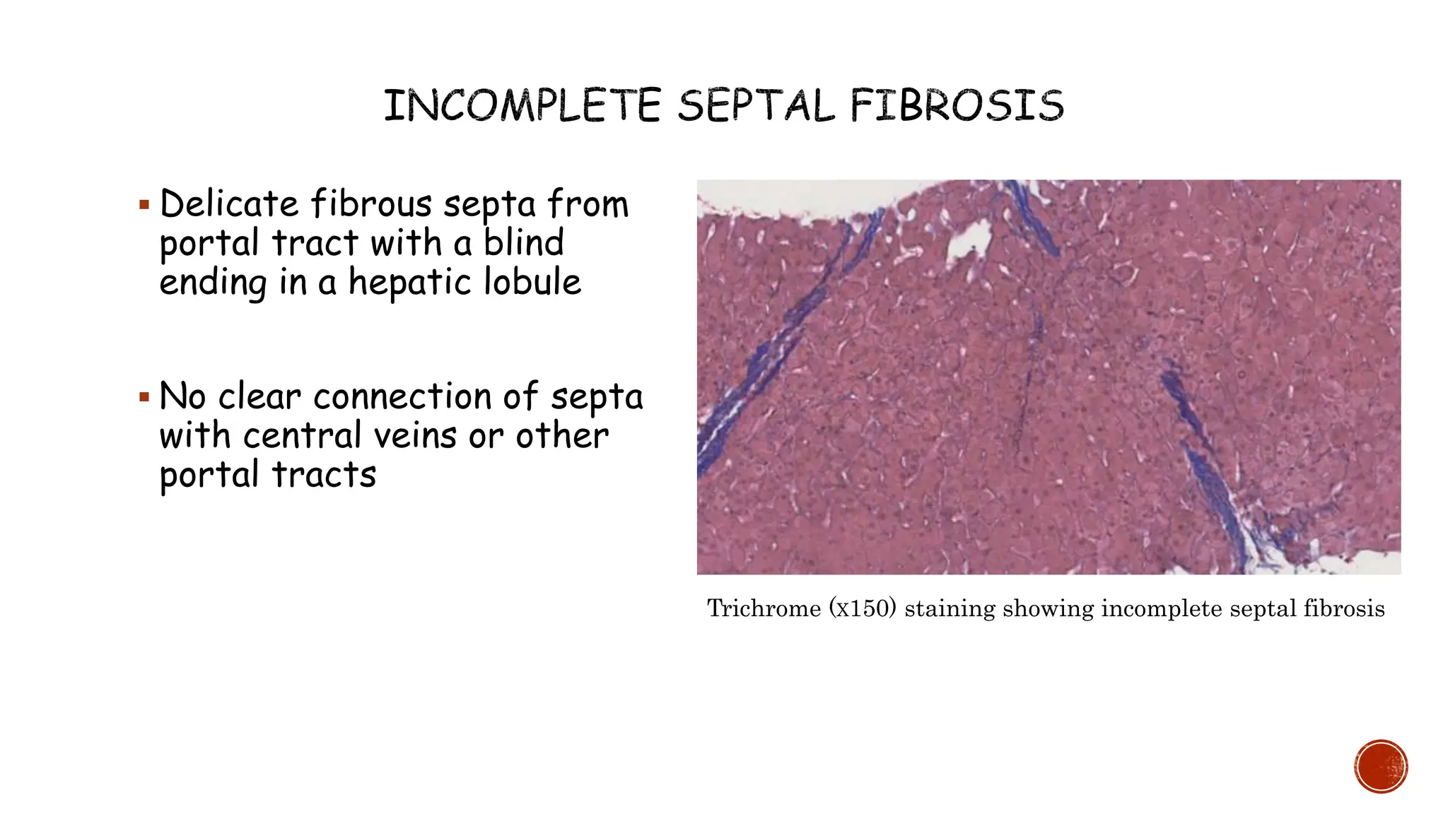 Portosinusoidal Vascular Disease (PSVD) | PPTX