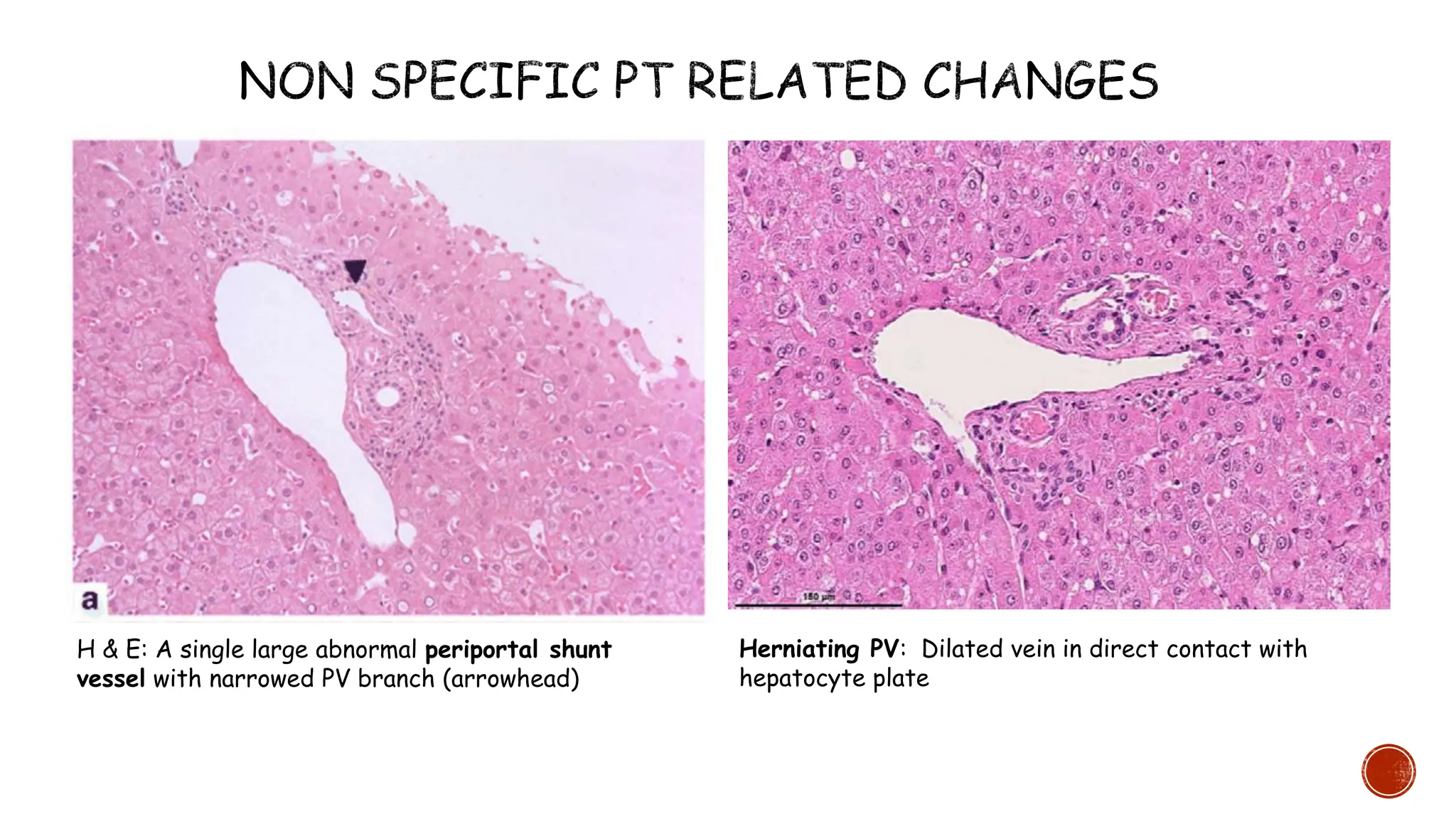 Portosinusoidal Vascular Disease (PSVD) | PPTX