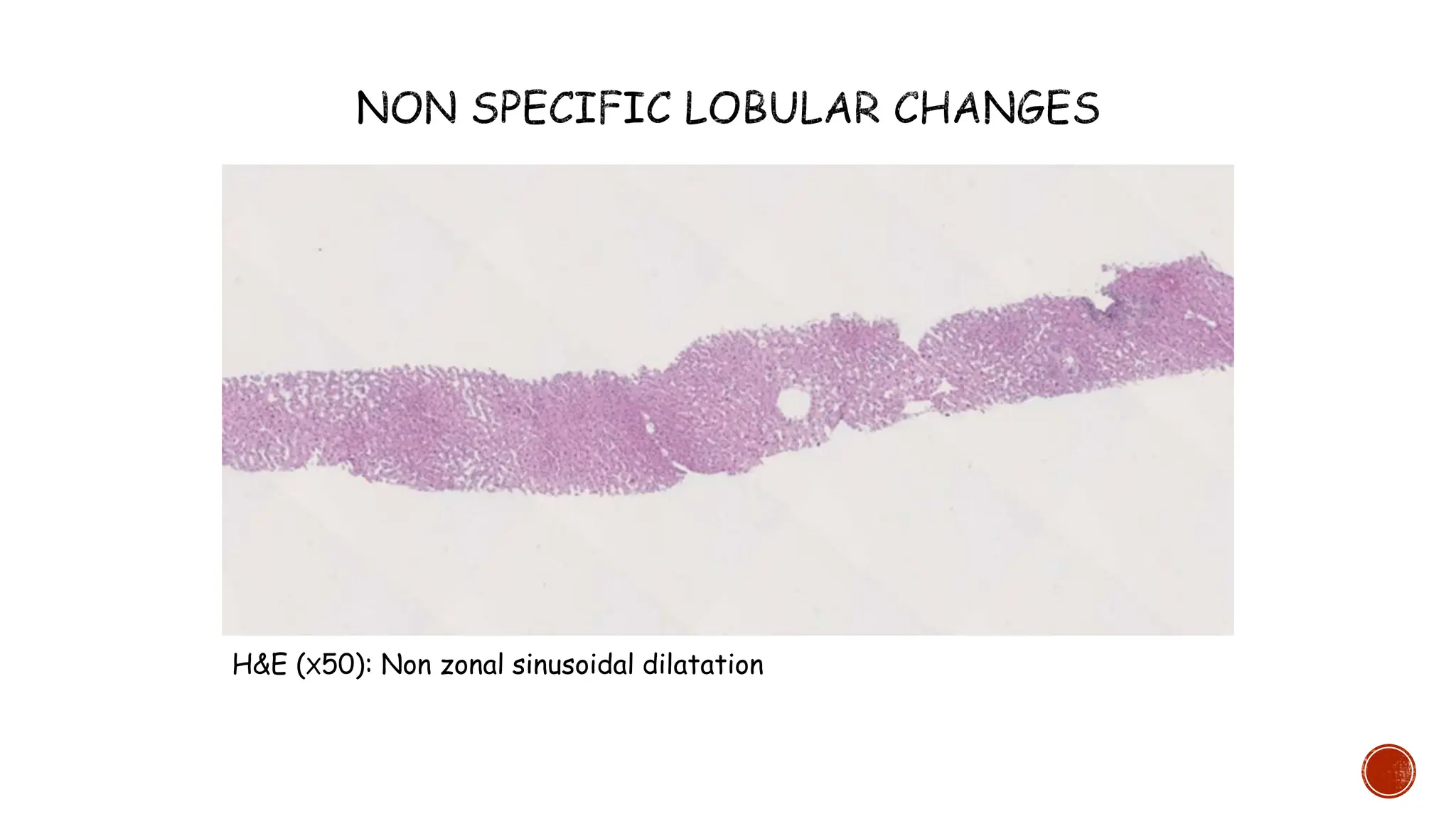 Portosinusoidal Vascular Disease (PSVD) | PPTX