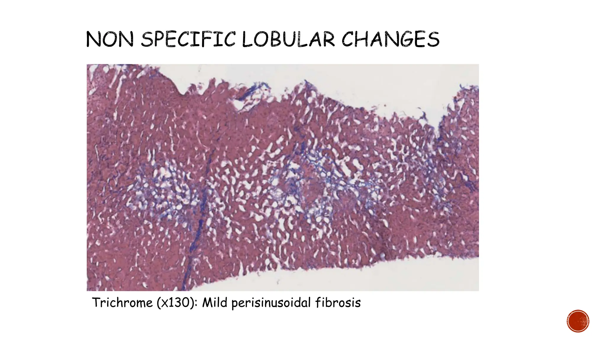 Portosinusoidal Vascular Disease (PSVD) | PPTX