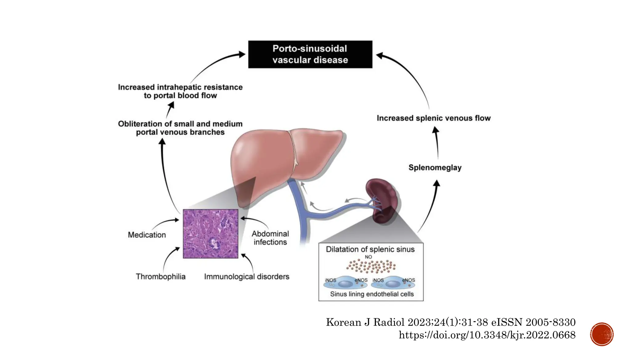 Portosinusoidal Vascular Disease (PSVD) | PPTX
