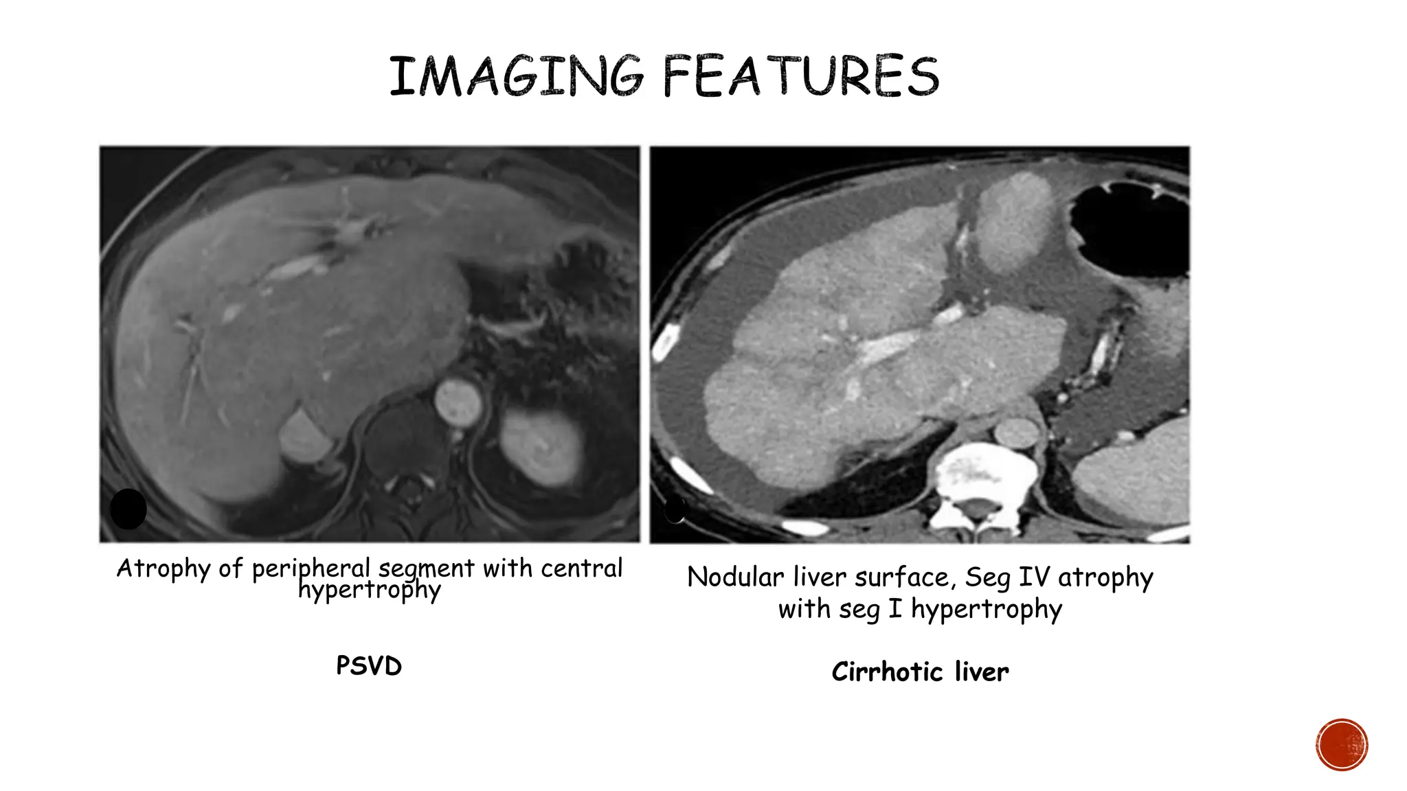 Portosinusoidal Vascular Disease (PSVD) | PPTX