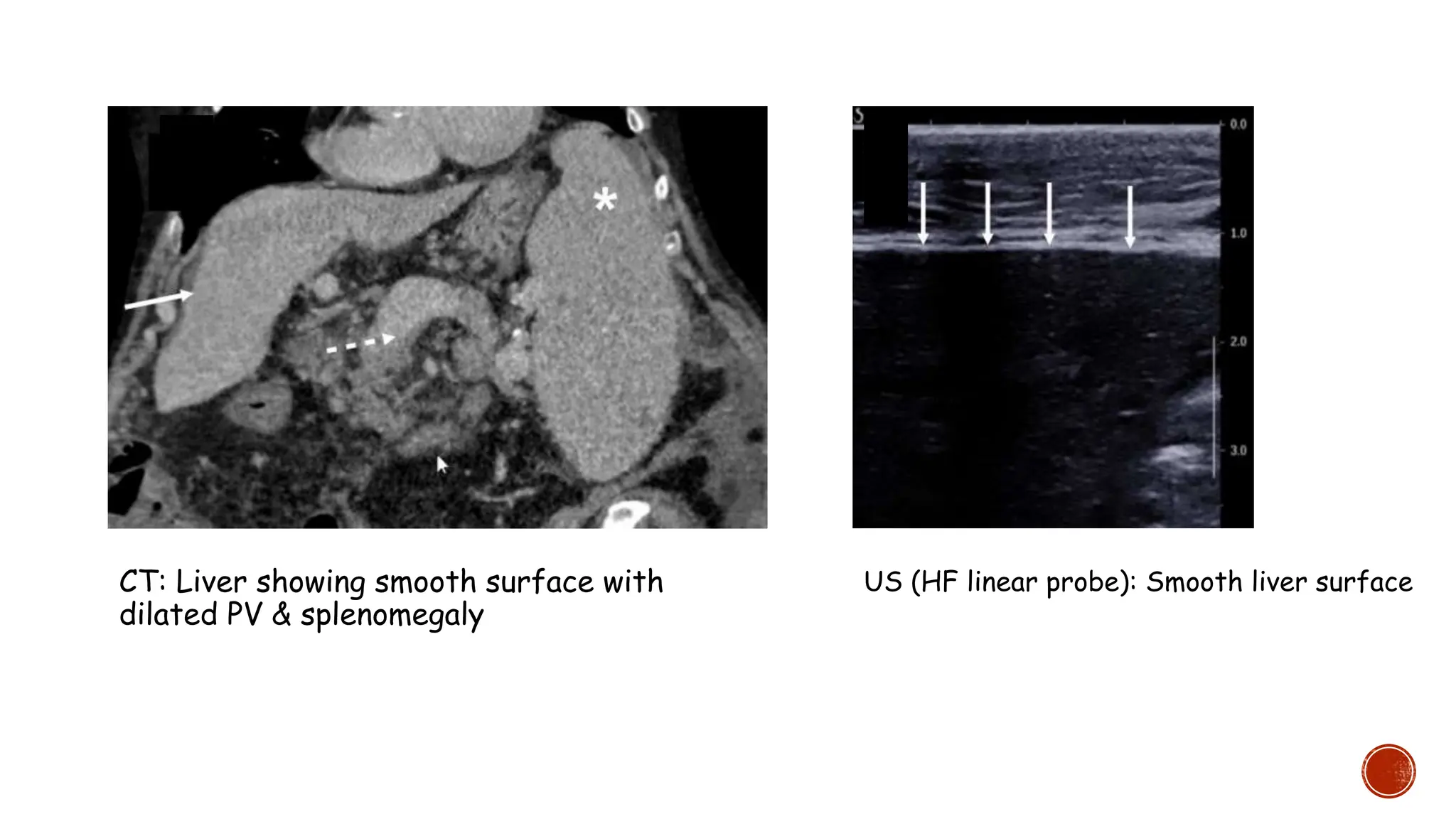 Portosinusoidal Vascular Disease (PSVD) | PPTX